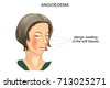 5+ Hundred Angioedema Royalty-Free Images, Stock Photos & Pictures ...