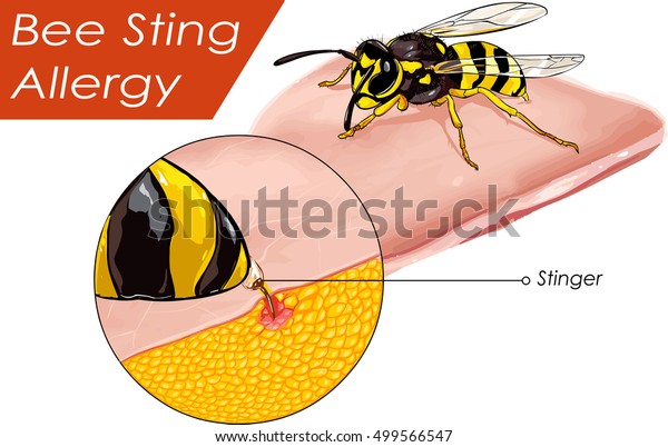 Vector Illustration Bee Sting Allergy Stock Vector (Royalty Free ...