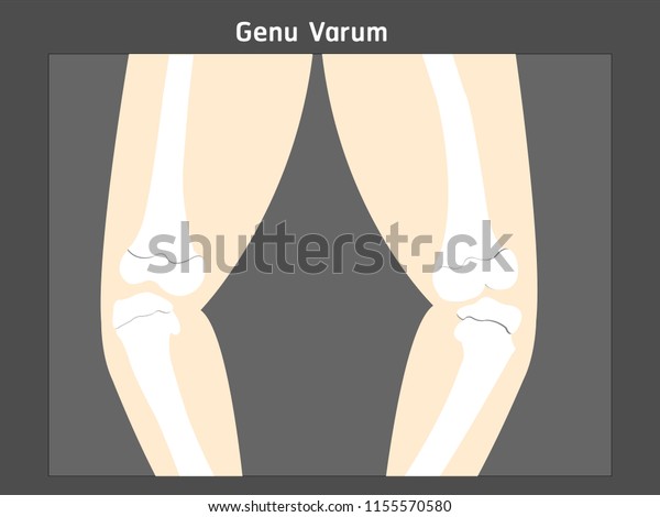 Vector Illustration Bowed Legs Genu Valgum Stock Vector (Royalty Free ...