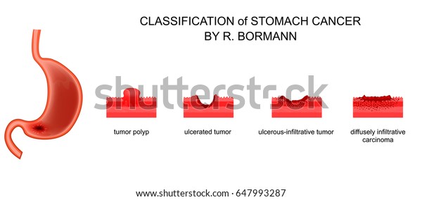 vector illustration of classification of gastric cancer