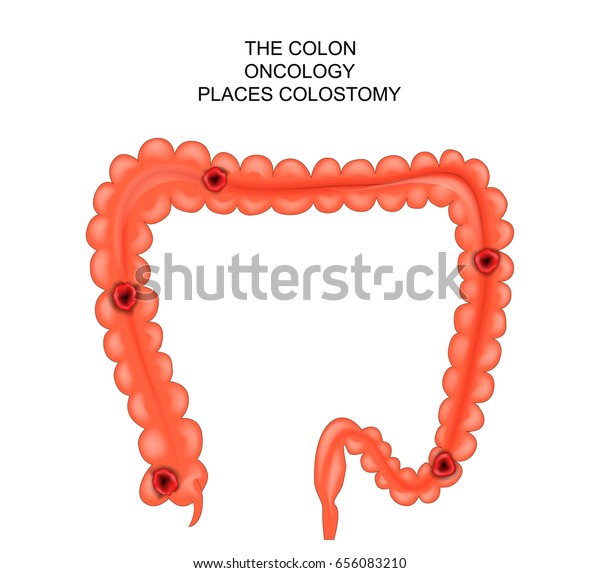 Vector Illustration Colostomy Place Surgical Intervention Stock Vector ...