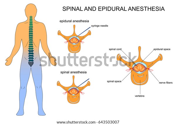 Vector Illustration Epidural Spinal Anaesthesia Stock Vector (Royalty ...