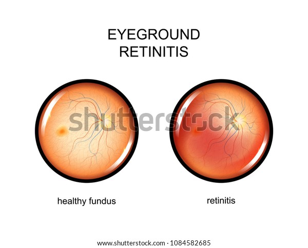 Vector Illustration Eye Fundus Retinitis Stock Vector (Royalty Free ...