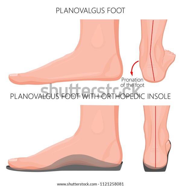 Vector Illustration Flat Planovalgus Foot Without Stock Vector (Royalty ...