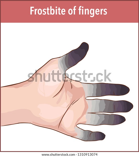 Vector Illustration Frostbite Finger Stock Vector (Royalty Free) 1310913074