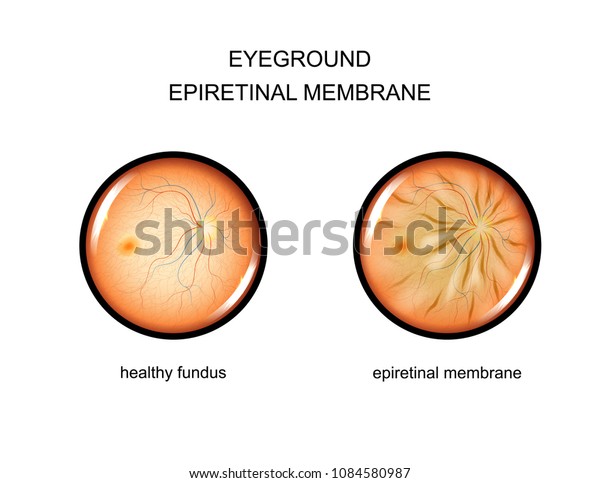「Vector Illustration Fundus Epiretinal Membrane」のベクター画像素材（ロイヤリティフリー ...