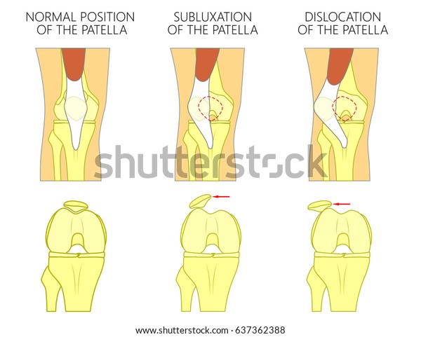 435 Patella dislocation: immagini, foto stock e grafica vettoriale ...