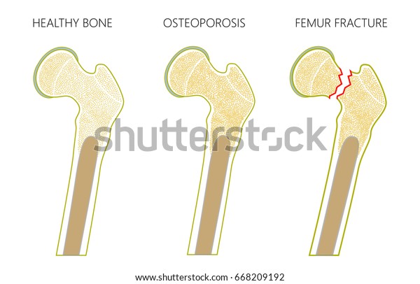 Vector Illustration Healthy Human Thigh Bone Stock Vector (Royalty Free ...