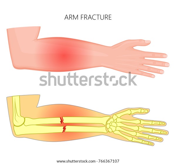 Vector Illustration Human Arm Shaft Fracture Stock Vector (Royalty Free ...