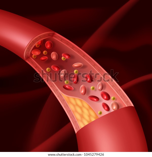 Vector illustration of human vascular atherosclerosis cutaway view of ...