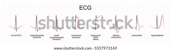 Vector Illustration Interpretation Ecg Myocardial Ischemia Stock Vector ...