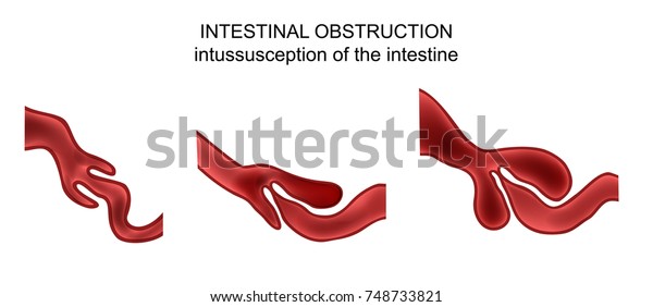 Vector Illustration Intussusception Intestine Obstruction: เวกเตอร์ ...