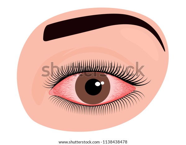 Vector Illustration Irritated Human Eye Redness Stock Vector (Royalty ...