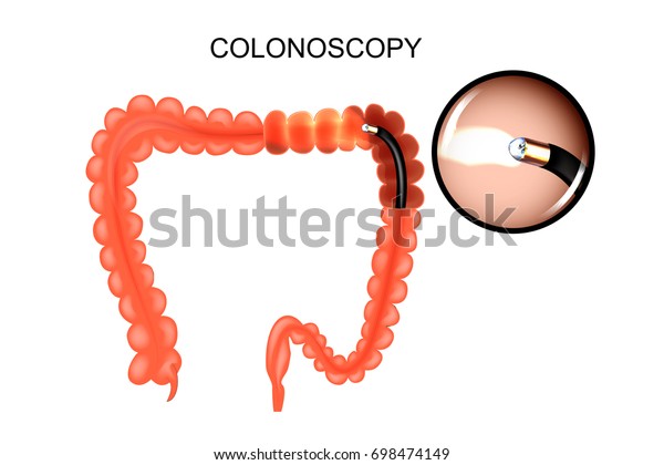 Vector Illustration Large Intestine Colonoscop Medicine 库存矢量图（免版税 ...