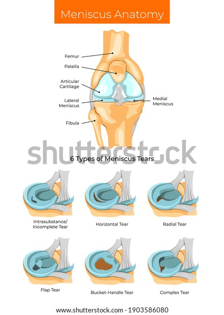 Vector Illustration Meniscus Anatomy 6 Types Stock Vector (Royalty Free ...