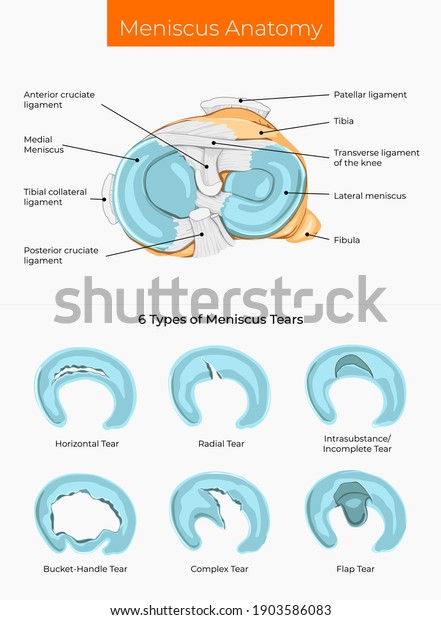 Vector Illustration Meniscus Anatomy 6 Types Stock Vector (Royalty Free ...