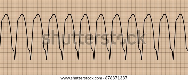 Vector Illustration Monomorphic Ventricular Tachycardia Cardiogram ...