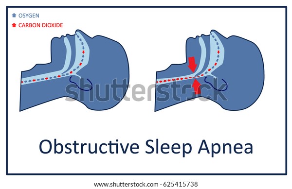 Vector Illustration Obstructive Sleep Apnea Stock Vector (Royalty Free ...
