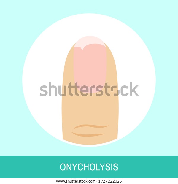 Vector Illustration Onycholysis Circle Icon Fingernail Stock Vector ...