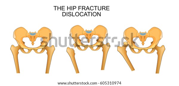 Vector Illustration Pelvis Hip Fracture Hip Stock Vector (Royalty Free ...