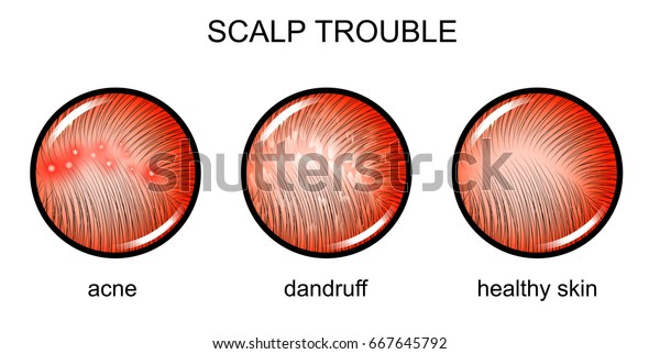 Vector Illustration Problematic Scalp Dermatology Stock Vector (Royalty ...