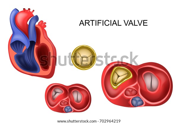 Vector Illustration Prosthetic Tricuspid Heart Valve Stock Vector ...