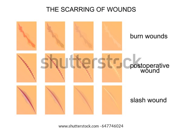 Vector Illustration Scarring Wounds Stock Vector (Royalty Free) 647746024