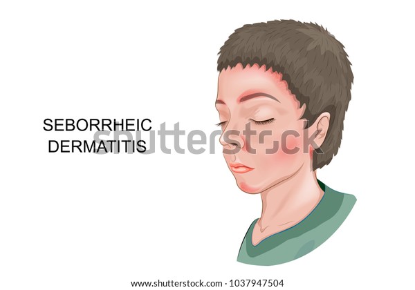 Vector Illustration Seborrheic Dermatitis Skin Stock Vector (Royalty ...