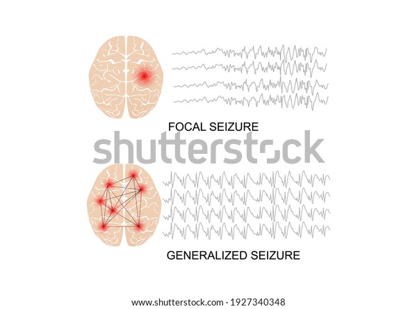 Vector Illustration Seizure Types Demonstrating By Stock Vector ...
