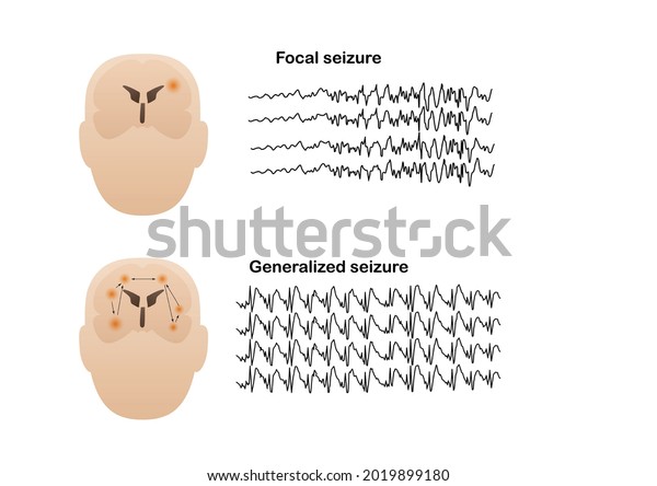 Vector Illustration Seizure Types Demonstrating Focal Stock Vector ...