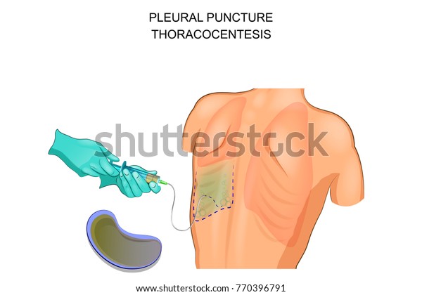 Vector Illustration Thoracocentesis Pleural Puncture Stock Vector ...