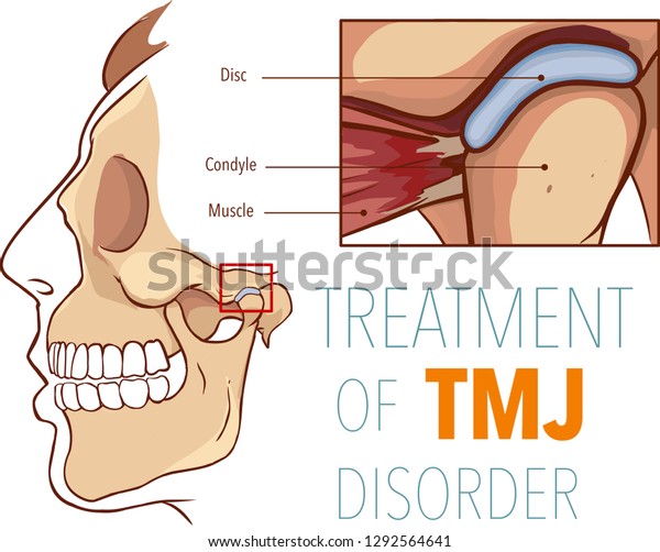 Vector Illustration Treatment Tmj Disorder Stock Vector Royalty Free