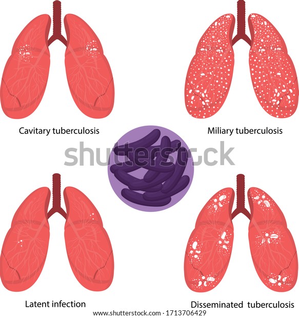 Vector Illustration Tuberculosis Mycobacterium Tuberculosis Stock ...