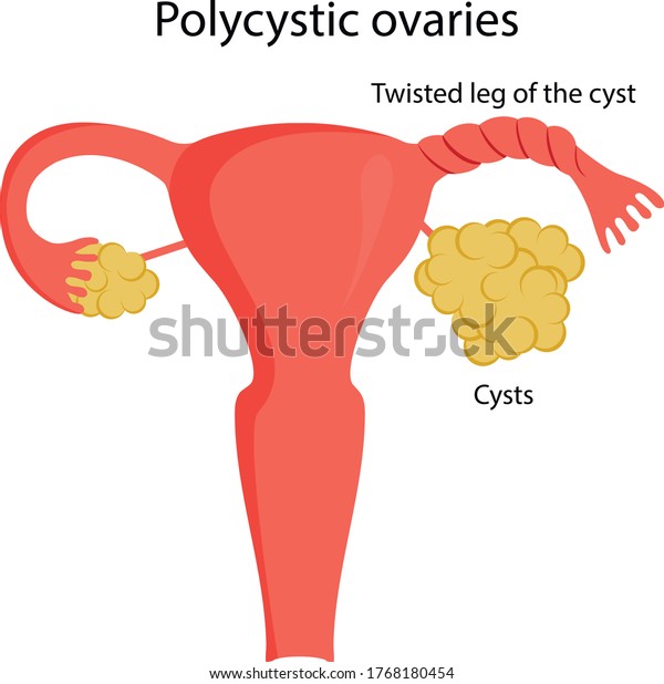 Vector Illustration Twisted Leg Cyst Ovarian Stock Vector (Royalty Free ...