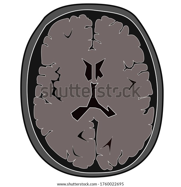Vector Images Normal Brain Ventricles Scalp Stock Vector (Royalty Free ...