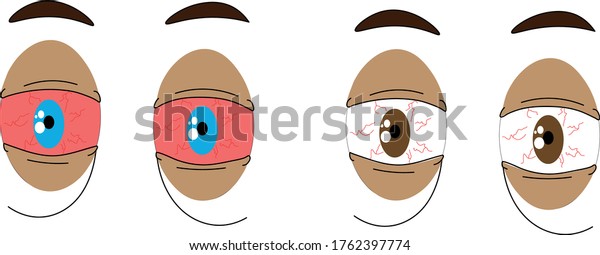 Vector Irritated Tired Eyes Stock Vector (Royalty Free) 1762397774 ...