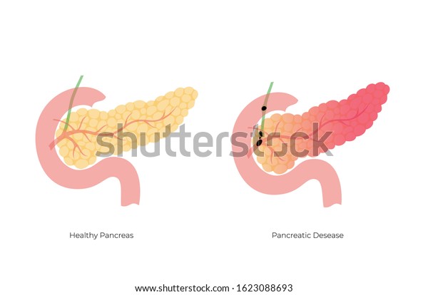 Vector isolated illustration of ill pancreas anatomy. Pancreatitis and ...