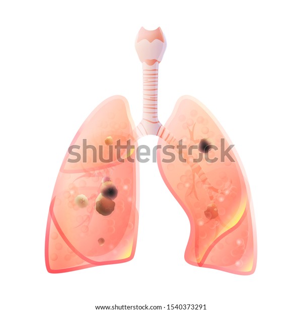Vector Isolated Illustration Lung Anatomy Cancer Stock Vector (Royalty ...