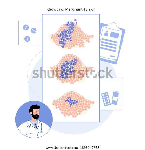 Vector Isolated Illustration Malignant Benign Tumor Stock Vector ...