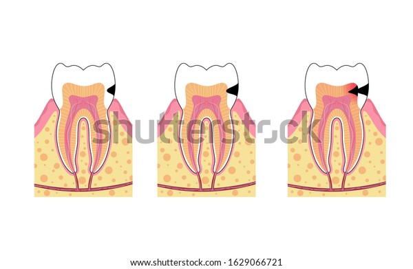 Vector Isolated Illustration Tooth Caries Stages Stock Vector (Royalty ...