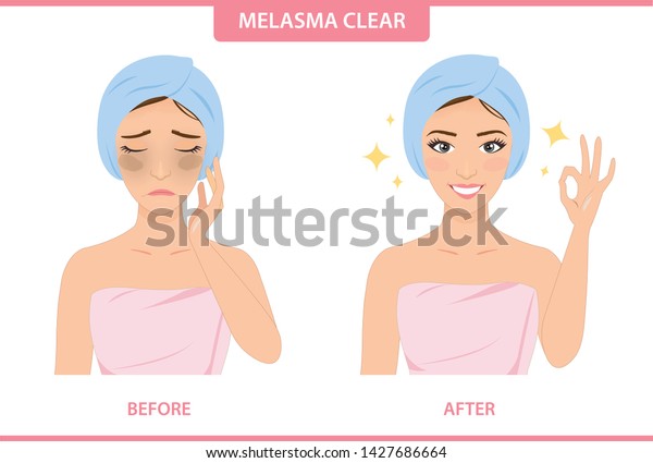 Vector Melasma Skin Before After On庫存向量圖（免版稅）1427686664 | Shutterstock