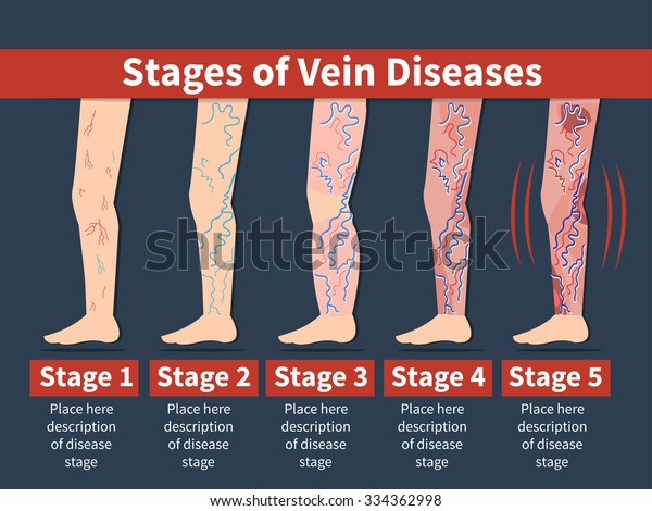 Vector Varicose Infographic Stage Vein Diseases Stock Vector (Royalty ...