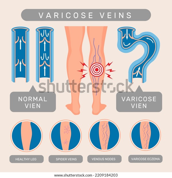 Venous Problems Infographic Template Venous Disease Stock Vector ...