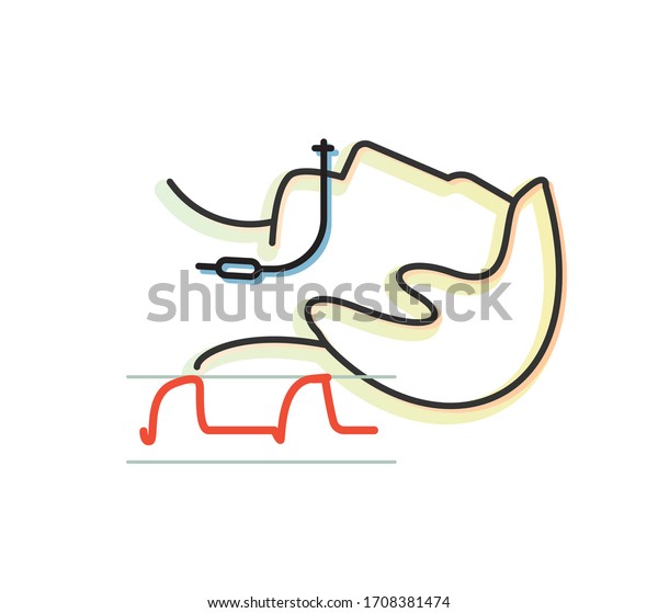 Lüftungs-Support - Trachealintubation - Symbol als: Stock-Vektorgrafik ...