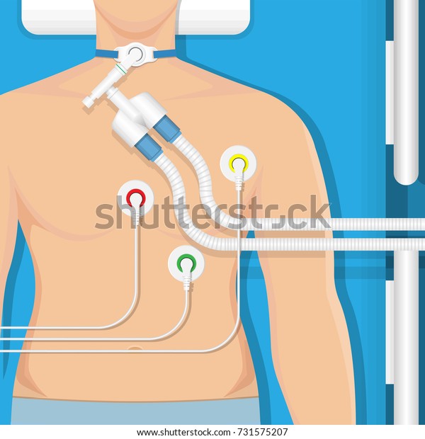 Ventilator Medical Machine Equipment Tracheostomy Patient Stock Vector ...