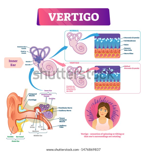 Vertigo Vector Illustration Labeled Medical Vestibular: stockvector ...