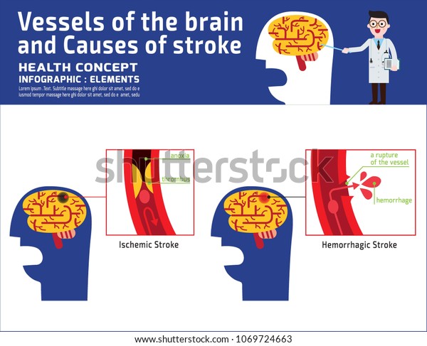 Vessels Brain Causes Stroke Infographic Disease Stock Vector (Royalty ...