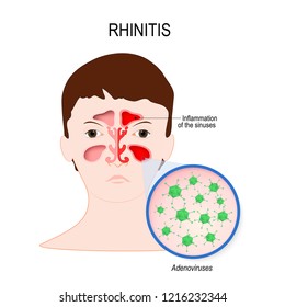 Bacterial Sinusitis Rhinitis Caused By Streptococcus Stock Illustration ...