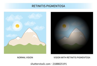 2,526 Normal vision Images, Stock Photos & Vectors | Shutterstock