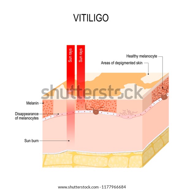 Vitiligo Skin Condition Characterized By Portions Stock Vector (Royalty ...